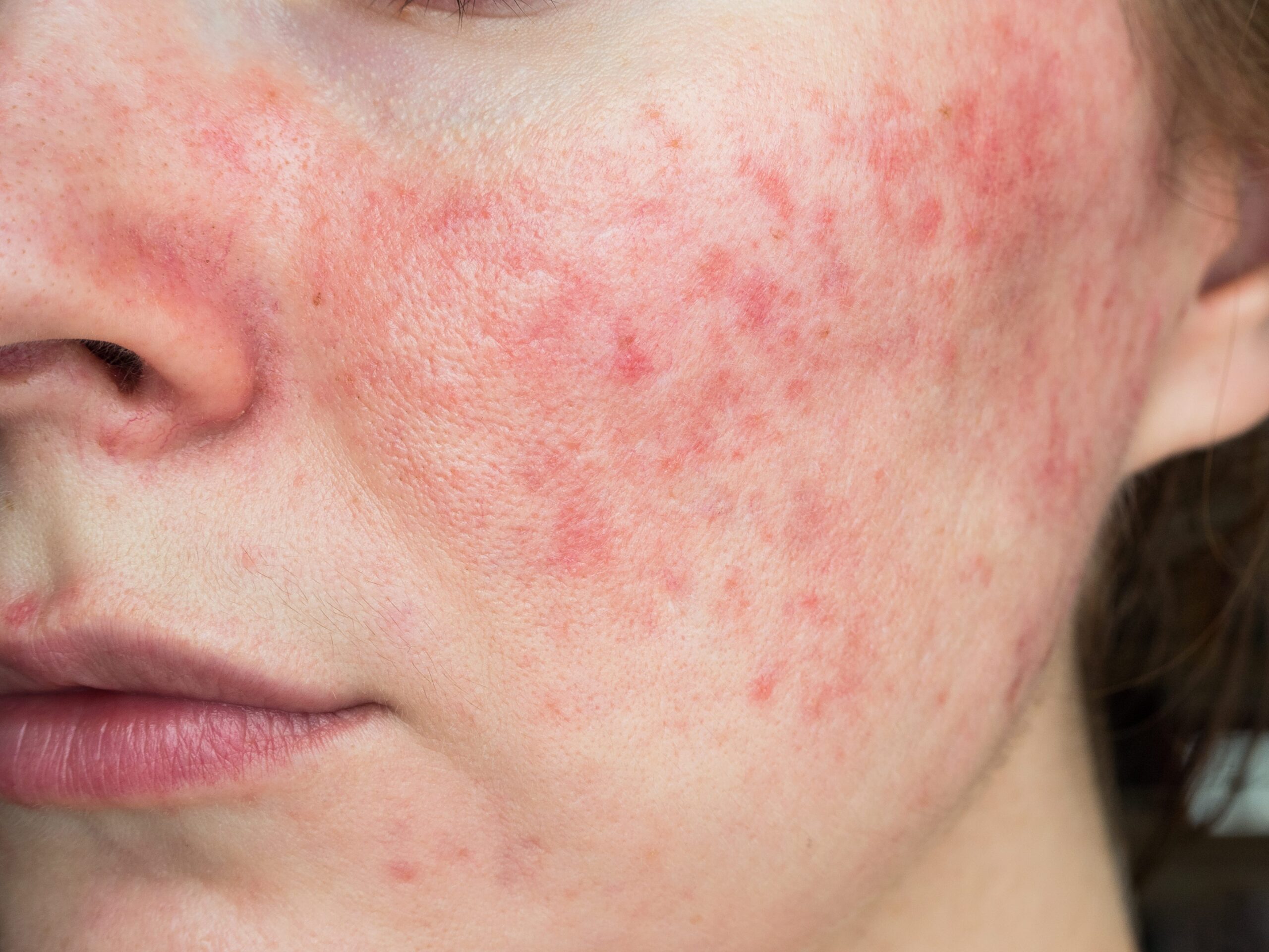 Rosacea: symptomen, behandeling en effectieve huidverzorging ...